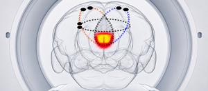 Towards deep brain stimulation without surgery | EurekAlert!