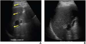 Multicenter study of ultrasound LI-RADS suggests switch for HCC ...
