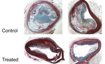 High-Risk Blockages [IMAGE] | EurekAlert! Science News Releases