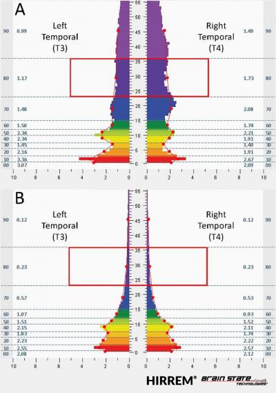 Post-traumatic stress symptoms reduced after use of HIRREM closed-loop ...