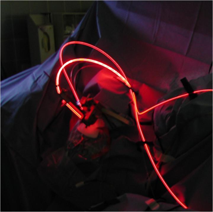 Medical Lasers [IMAGE] | EurekAlert! Science News Releases