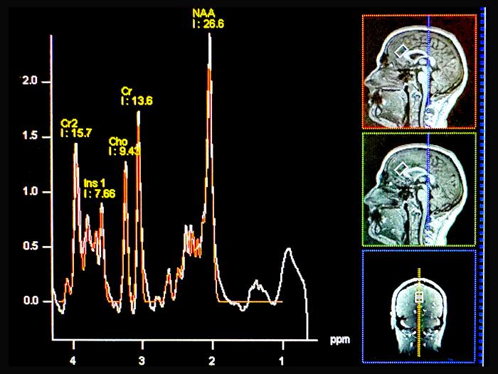 Low Choline Levels In The Brain Associated With Anxiety Disorders
