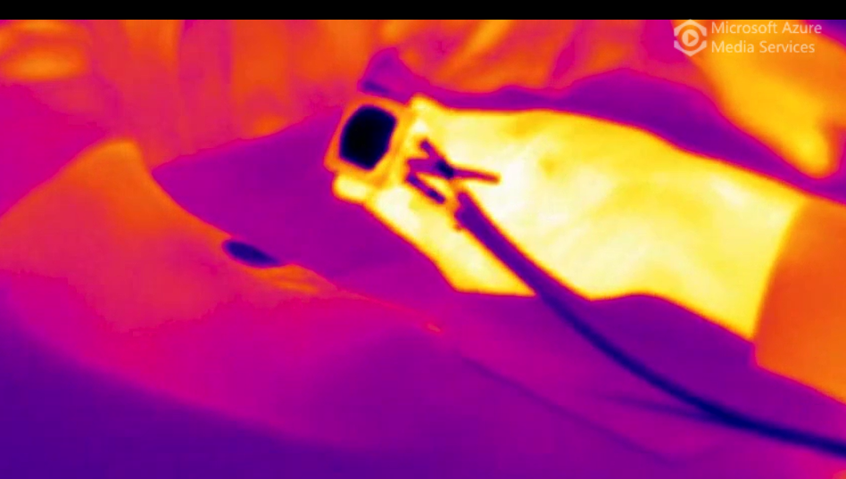 Amputees feel warmth in their missing hand | EurekAlert!