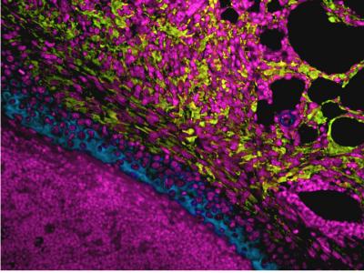 Micrograph of S. aureus Skin Abscess [IMAGE] | EurekAlert! Science News ...