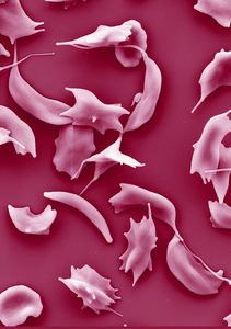 Alzheimer’s drug demonstrates efficacy against sickle cell anemia ...