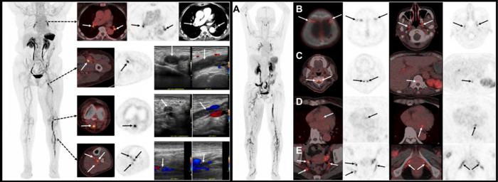 SNMMI Image of the Year: Novel PET Tracer Detects Deep Vein Thrombosis ...